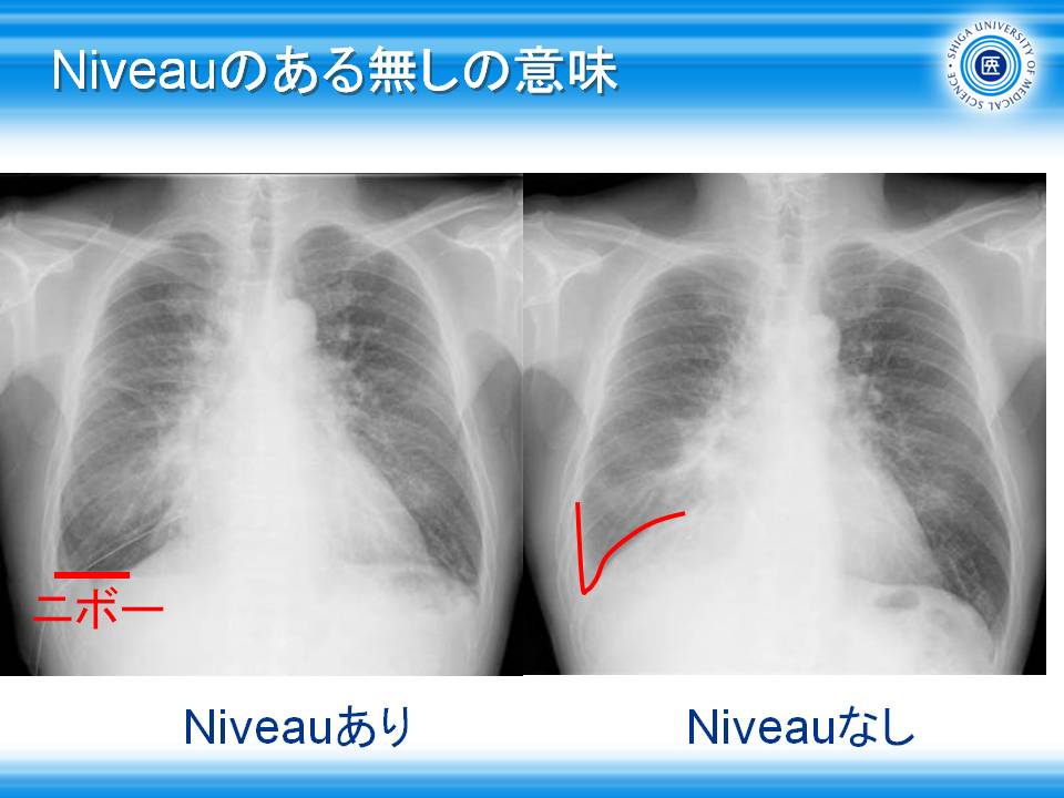 胸部X線道場: やさしイイ呼吸器教室